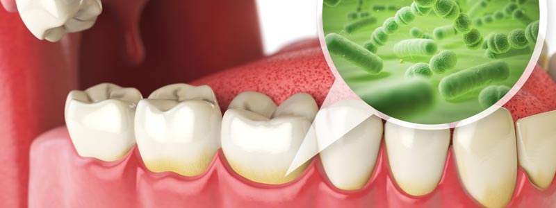 Acid Reflux: How Can I Protect My Teeth from Acid Reflux? - My Dentist ...