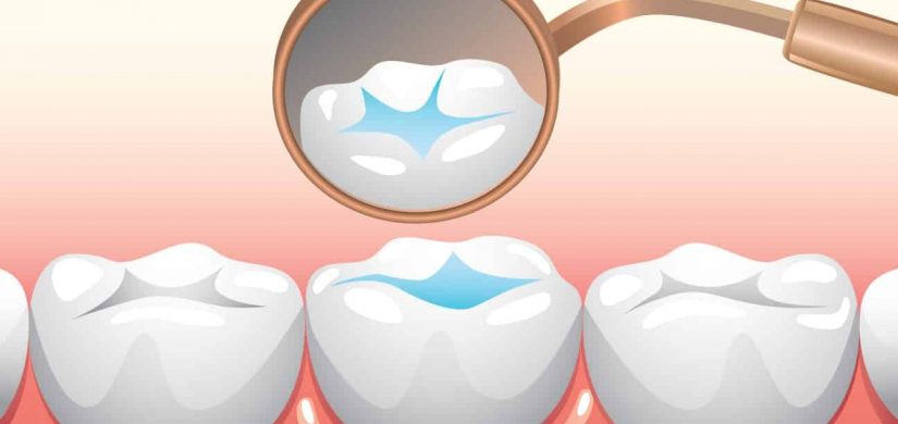 Smooth Surface Cavities - My Dentist Toluca Lake