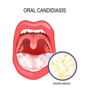 Oral Thrush: Symptoms, Causes, and Treatments - My Dentist Toluca Lake