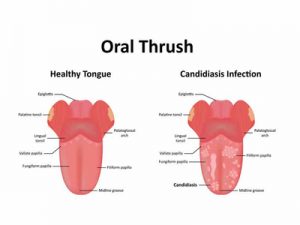 Oral Thrush: Symptoms, Causes, and Treatments - My Dentist Toluca Lake
