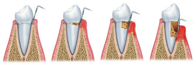 Tooth Mobility and Periodontal Therapy - My Dentist Toluca Lake