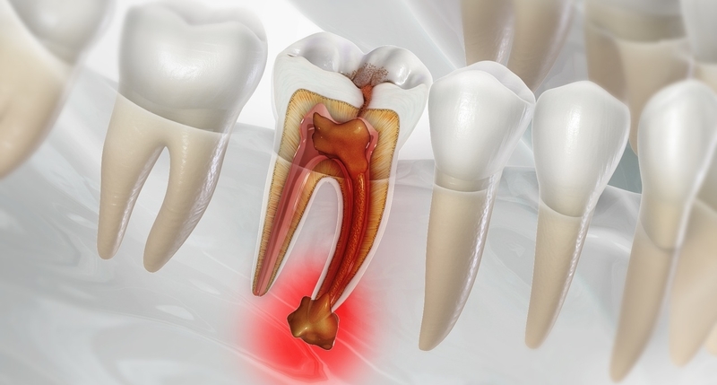 What Does it Mean that I Have an Abscessed Tooth? - My Dentist Toluca Lake