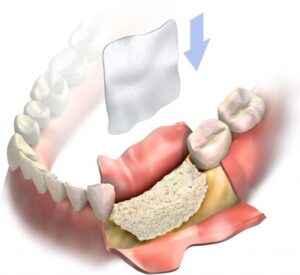 The Role Of Collagen Membranes In Dental Bone Preservation - My Dentist ...