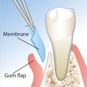 The Role Of Collagen Membranes In Dental Bone Preservation - My Dentist ...