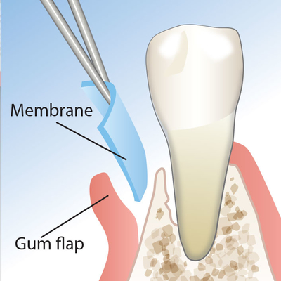 The Role Of Collagen Membranes In Dental Bone Preservation - My Dentist ...