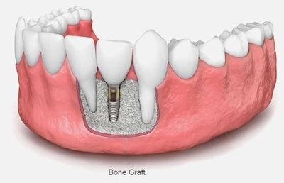 The Role Of Collagen Membranes In Dental Bone Preservation - My Dentist ...