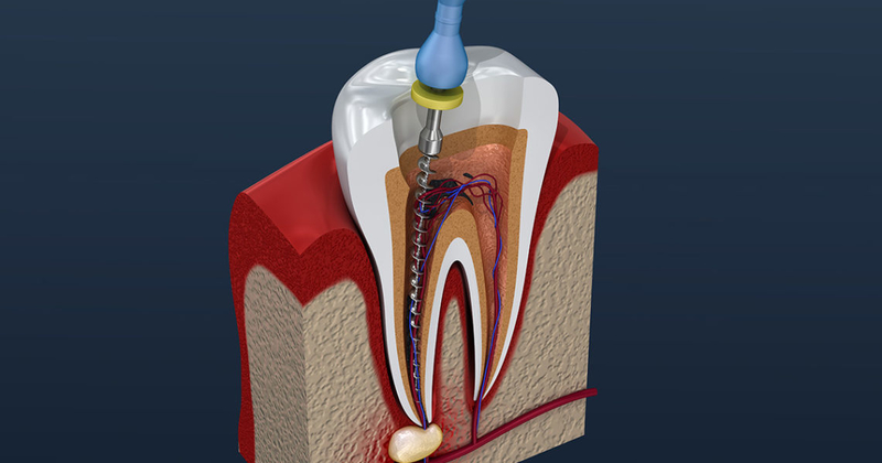 Root End Procedures Can Save Teeth - My Dentist Toluca Lake
